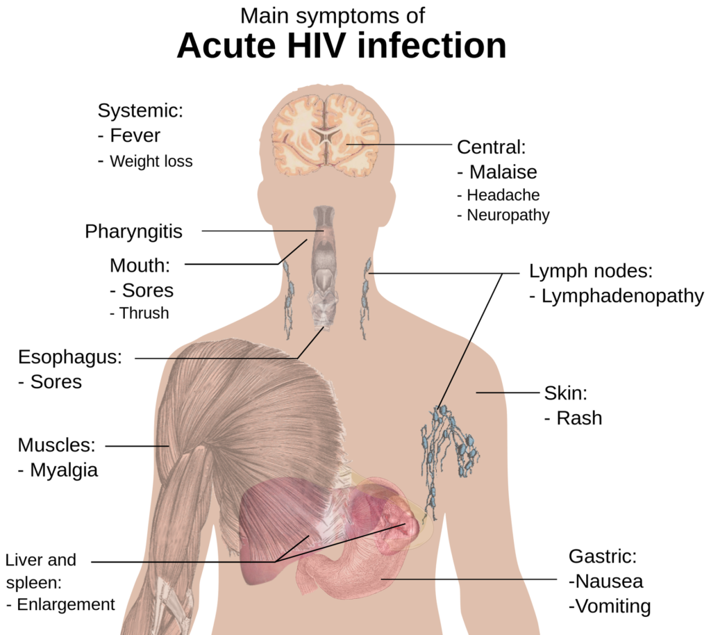 HIV infection symptoms – MOBIEG HIV infection symptoms – MOBIEG